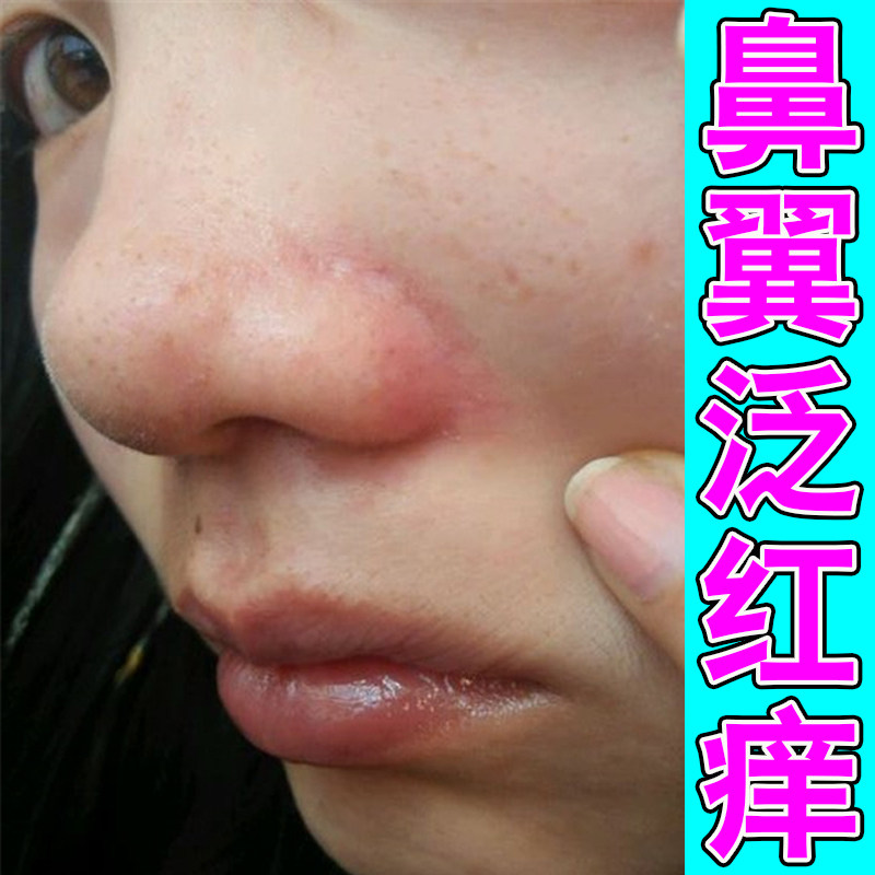 鼻子两侧发红起皮鼻翼两边泛红干燥起皮专用草本乳膏鼻子两侧泛红