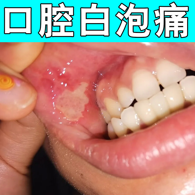 口腔白念珠菌嘴巴舌头烂口腔内壁起泡喷剂