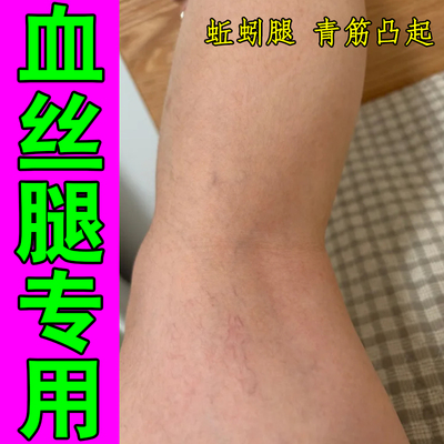 小腿表层网状红纹腿部细小红丝显露下肢浅表细小筋络肌肤纹路可见