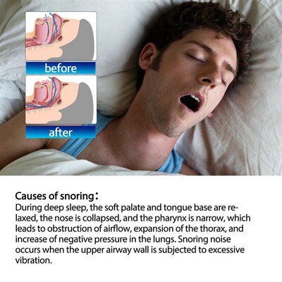 Snoring prevention patch, sleeping ventilation nasal patch