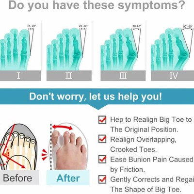 6pcs Silicone Gel Hallux Valgus Orthopedic Protector Toe Bun