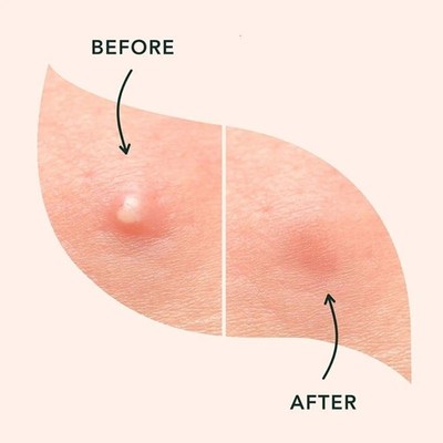 96Pcs/set Face Patch Hydrocolloid Acne Pimple Patches for