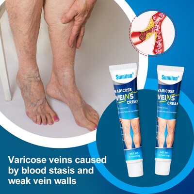 Varicose Veins relieves Cream Leg Vasculitis Phlebitis Spide