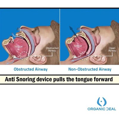 Anti Snoring Mouthpiece Tongue Retainer Helps to Eliminate S