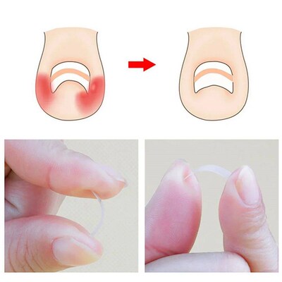 10-100PCS/Bottle Ingrown Toenail Correction Tool Ingrown Toe