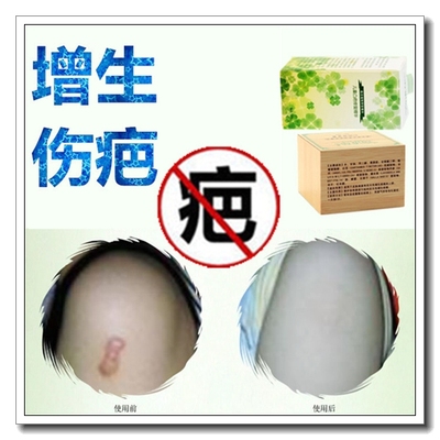 红色疤痕灵硅铜凝胶祛除色沉怯疤膏淡化烧伤印去摔伤修复增生凸起