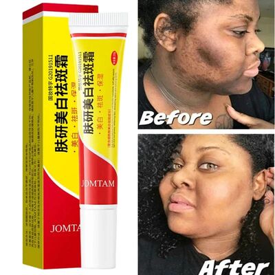 Niacinamide Face Lightening Cream Weaken Chloasma Melasma Me