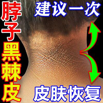 脖子黑棘皮症去除色素皮肤沉淀颈部黑脖子美胳膊腋下私处霜药膏