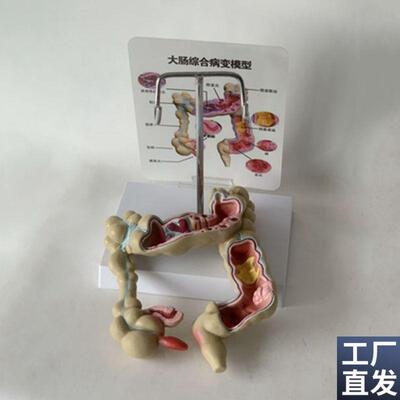 康泰教具炎阑尾盲肠大肠扭转x阻塞梗阻人体消化道医药促销结肠病