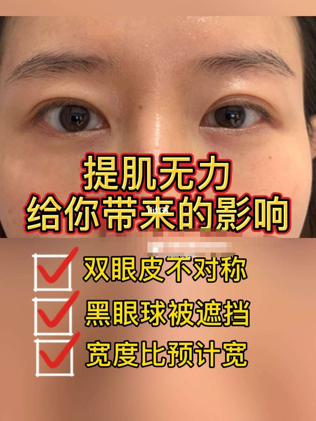 草本提上睑肌精华 改善肌无力眼皮不对称 新客限拍一瓶拍多不发货