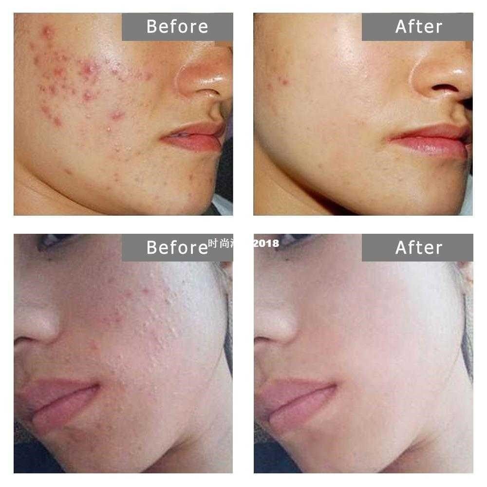 Comedone Pimple Anti Acne Treatment Acne Scar Blackhead Remo_虎窝淘