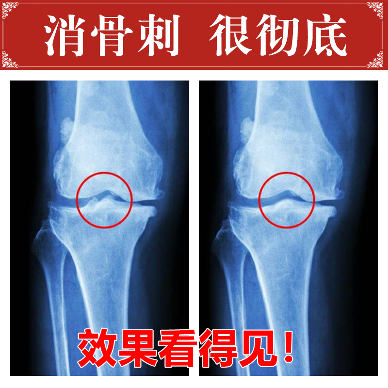 Bone Tinged Paste to TX root knee lid Bone Thorn Special Medicine ...