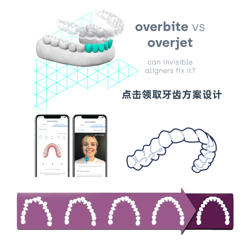 Invisible teeth aligners: imported clear braces, say goodbye to ...