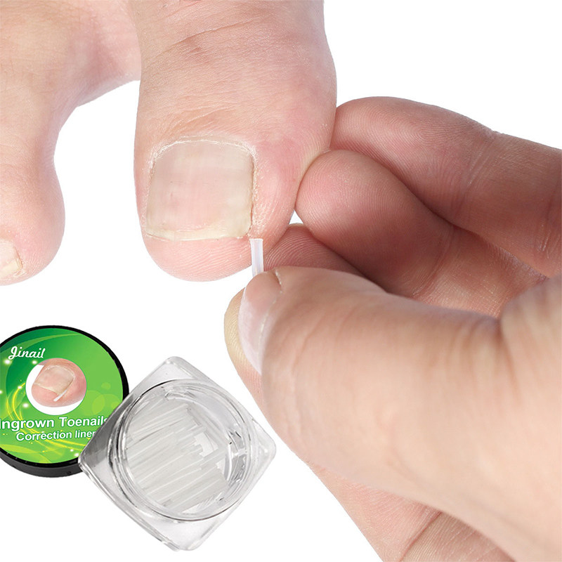 Ingrown Nail Saviour: Nail Straightener & Filler Pad - Say Goodbye to ...