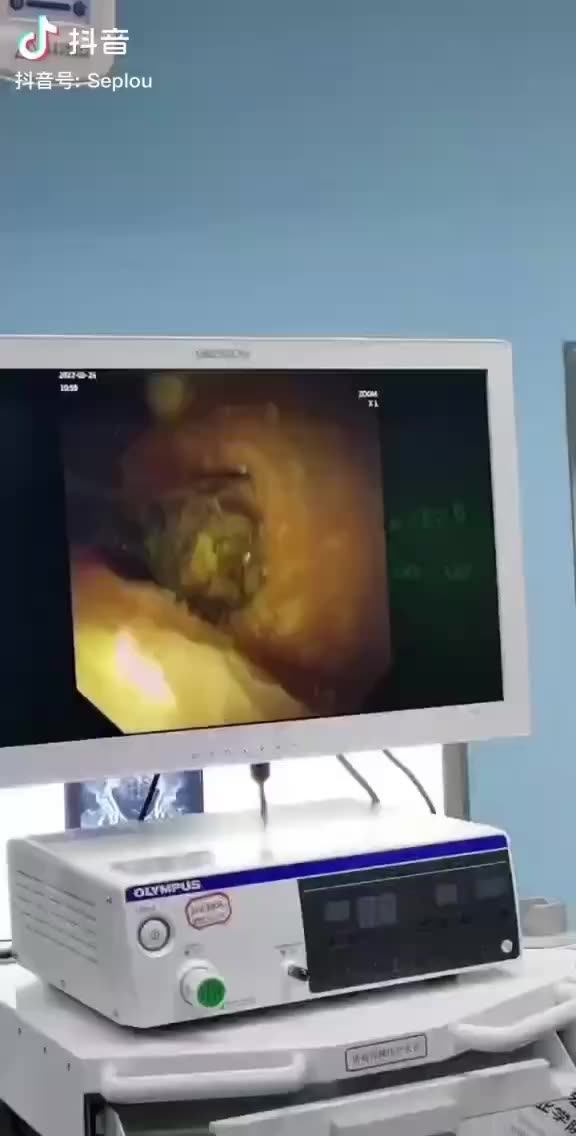 Hemoclip Disposable Endoscopic Flexible Rotatable Hemoclip ...