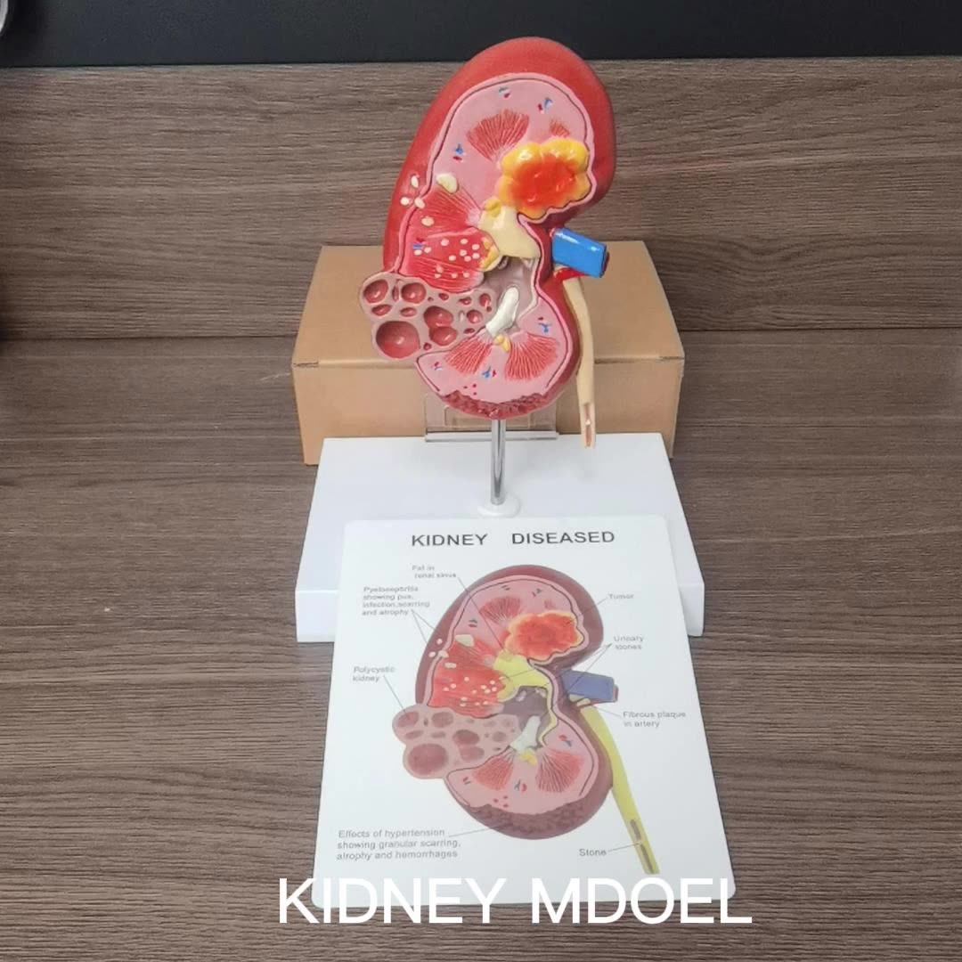 Life Size Diseased And Normal Kidney Anatomical Model Urinary System ...