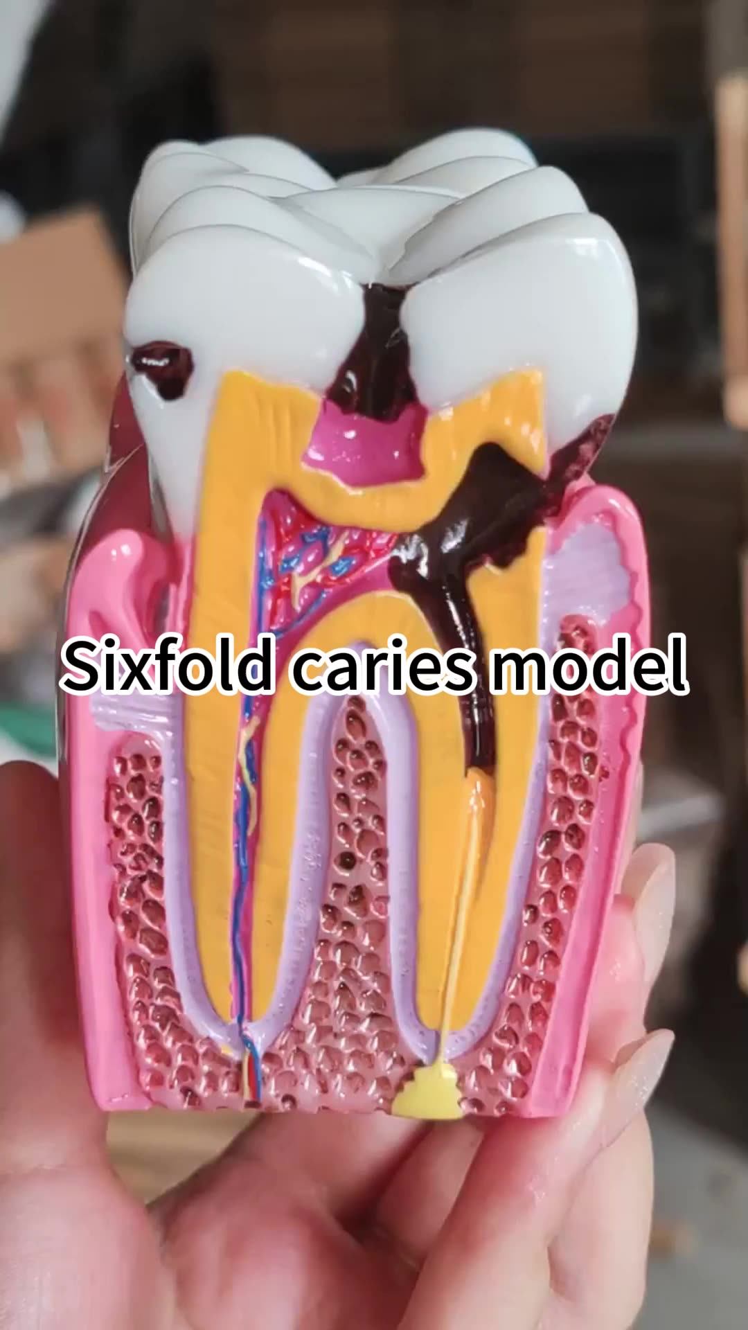 Dental Caries Nursing Model An Enlarged Anatomical Model Of Dental ...
