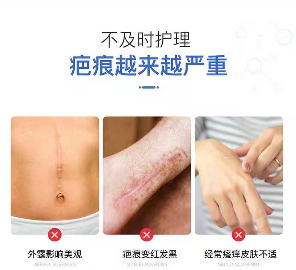 [USD 9.50] American ScarsKeloCote Buckback Buck Buck Buck Buck Paste ...