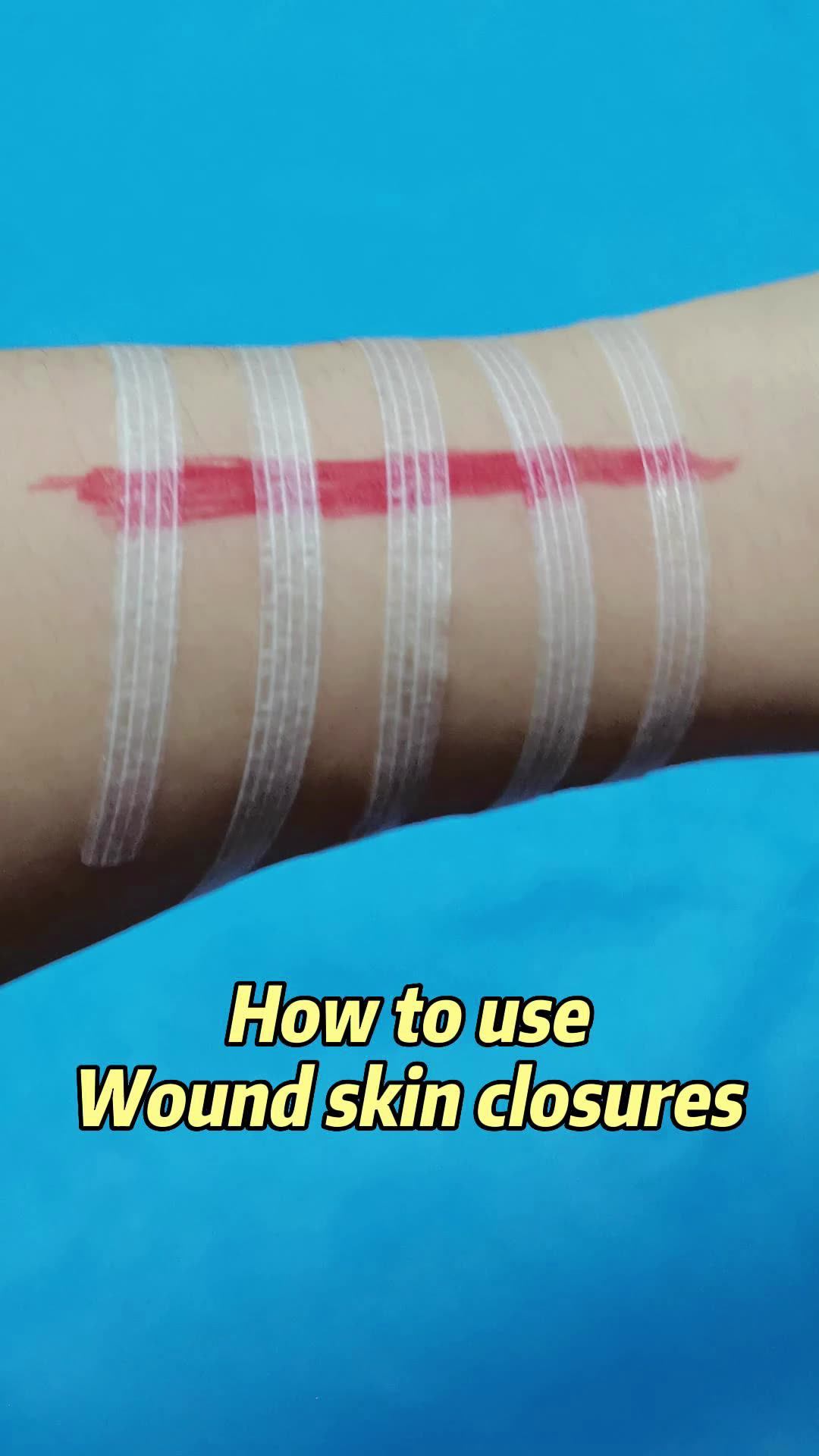 Hospital Surgical Sterile Wound Closure Strips Steri-strip Tape Skin ...