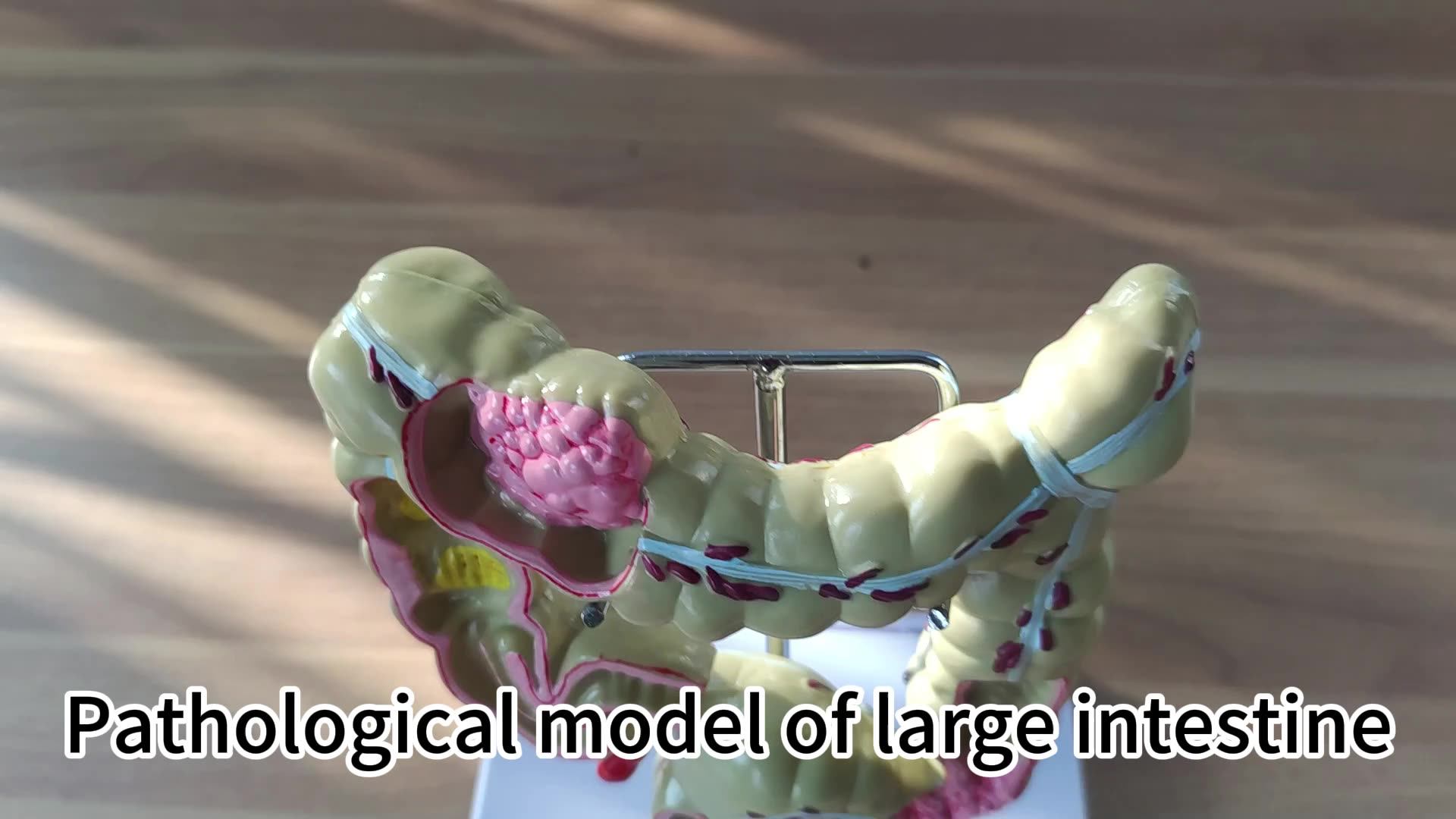 Large Intestine Rectum Pathology Medical Anatomical Model Medical ...