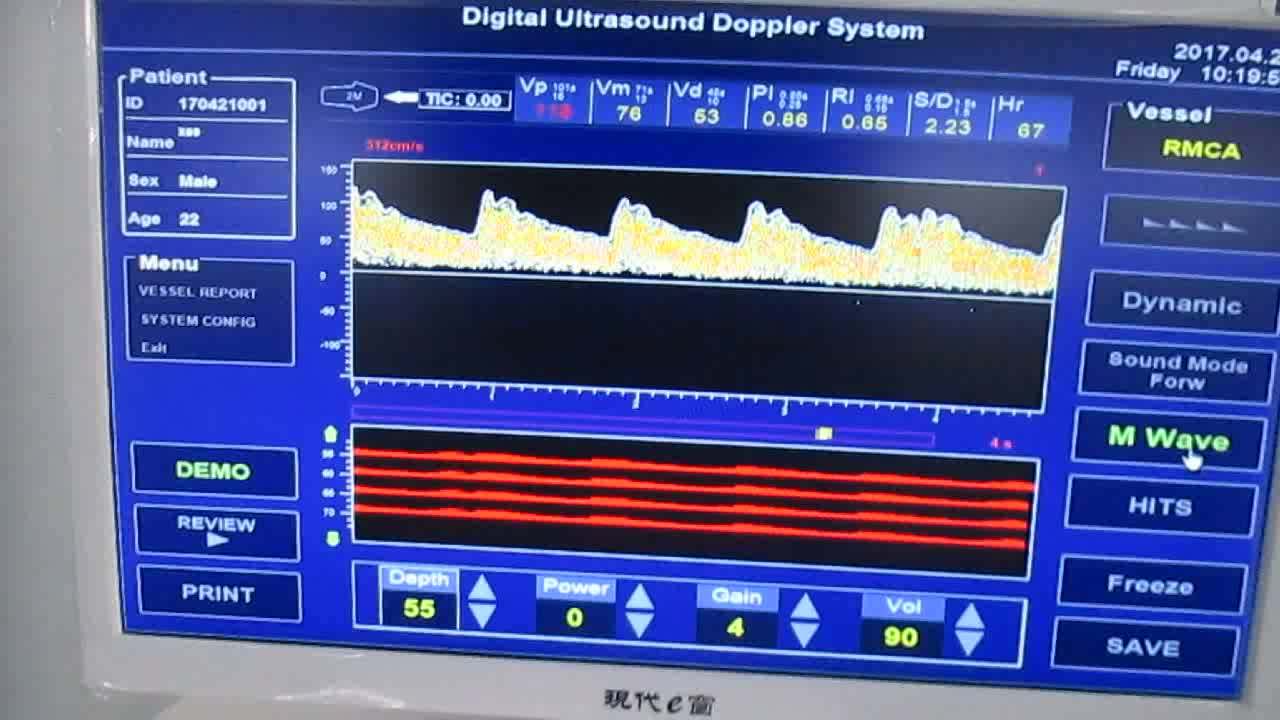 Tcd Ultrasound Machine Transcranial Doppler With M Mode - Buy Tcd,Tcd ...