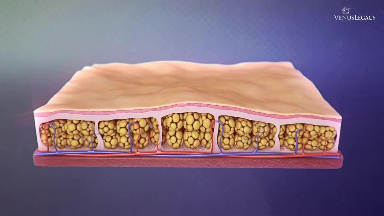 Venus Legacy Machine Radiofrequency Weight Reduce Slimming Radio ...