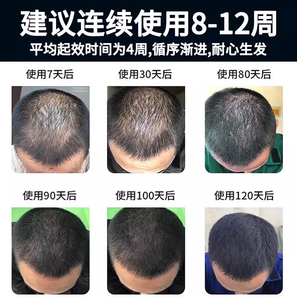 reten five泰国米诺地尔搽剂5%：告别脱发，重获浓密秀发🌿 -国际白发脱发-淘宝百科网