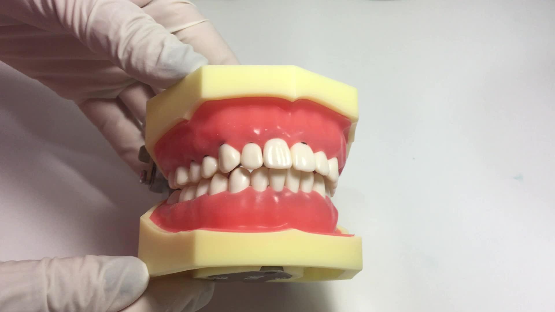 Periodontal Disease Practice Model Demonstrate Calculus,Gingivitis ...