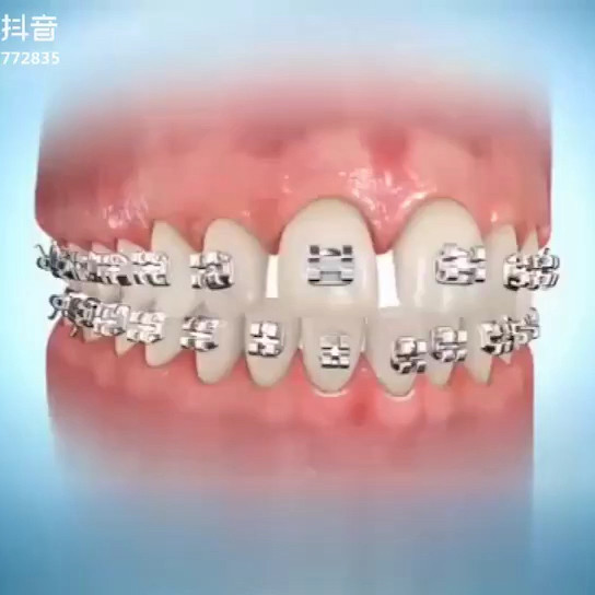 Denrum Orthodontics Professional Roth Mbt Dental Brackets Ortho Metal ...