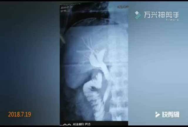 Disposable Endoloop,Ligation Loop Vessels Ligation - Buy Medico ...