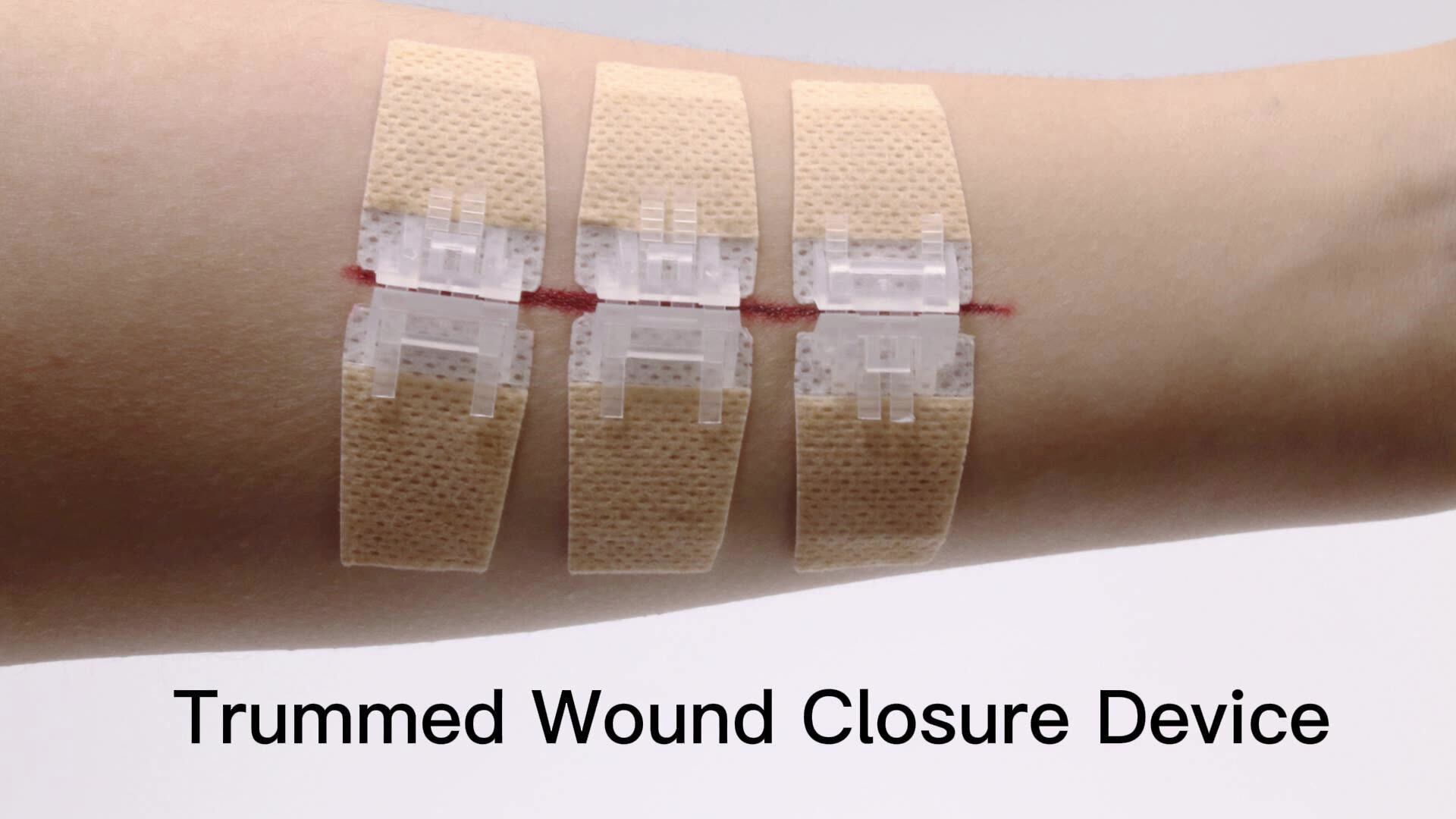 Trummed Emergency Laceration Closures Wound Closure Steri Strip Without ...