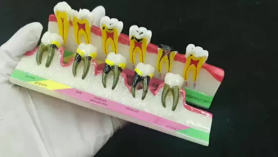 Teeth Periodontal Disease Model Dental Teeth Model Dentistry Teaching ...
