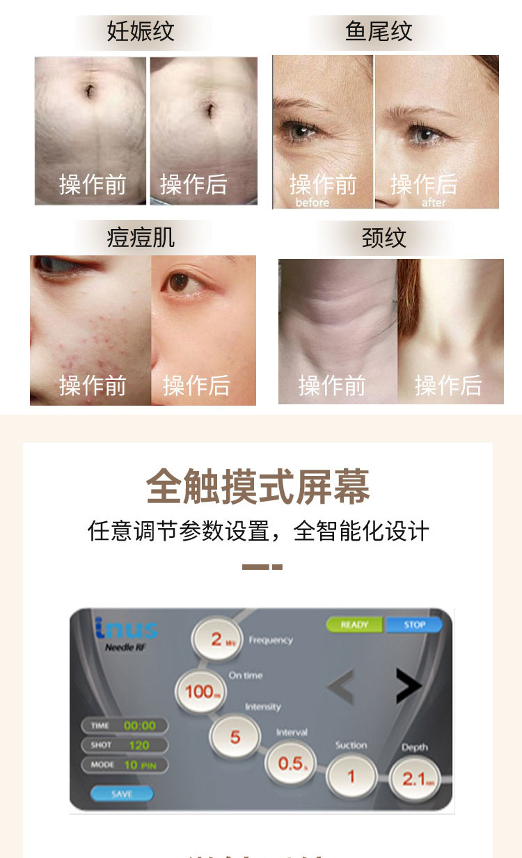 伊诺思INUS黄金RF微针怎么用才不翻车？保姆级抗衰操作指南来了！_电子美容仪器械_淘宝美妆网