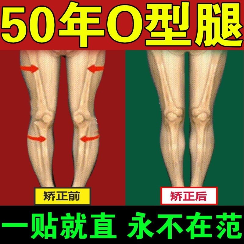 [USD 12.92] o-shaped leg orthosis straight leg sockliner o-shaped x-leg ...