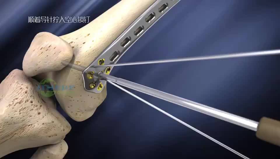 Finger External Fixator Kit With Screw Mini Fragment External Fixator ...